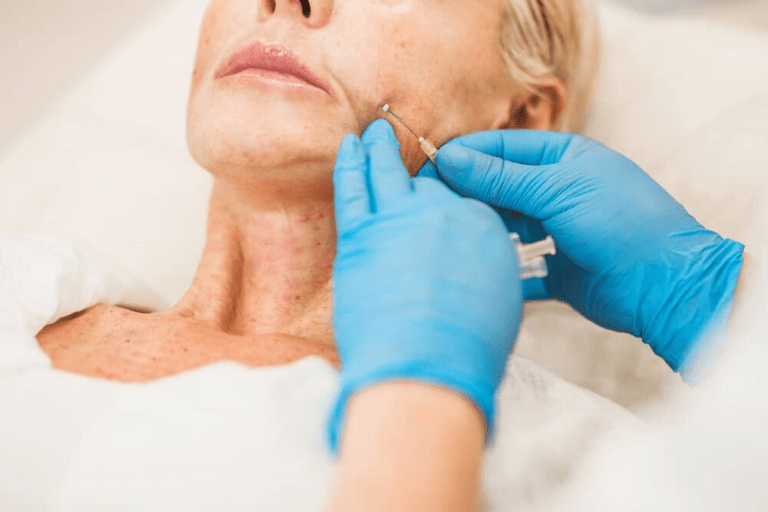 Thread Lift Gone Wrong | Verified Cases - Blushastic