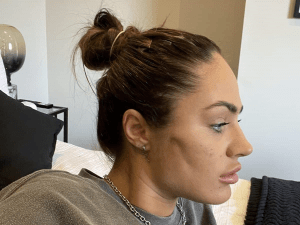 Thread Lift Gone Wrong | Verified Cases - Blushastic