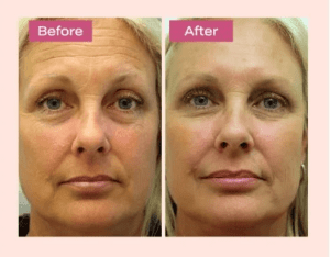 Evertone Microcurrent Reviews | Best At-Home Facial Kit? - Blushastic